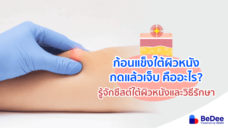 ก้อนแข็งใต้ผิวหนัง กดแล้วเจ็บคืออะไร รู้จักซีสต์ใต้ผิวหนังและวิธีรักษา
