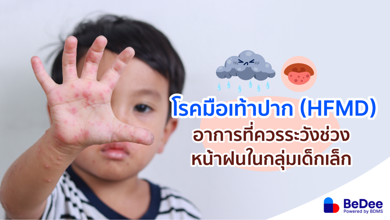 โรคมือเท้าปาก (HFMD) อาการที่ควรระวังช่วงหน้าฝนในกลุ่มเด็กเล็ก - BeDee